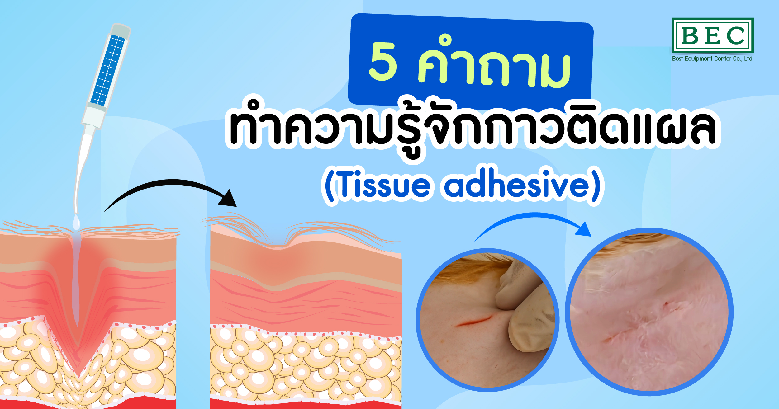 กาวติดแผล (Tissue adhesive) คือกาวทางการแพทย์ที่ใช้เชื่อมขอบ | Best ...